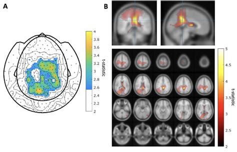 A Maps Of Meg Sensors Where The Expectation Parameter η T