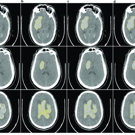 Hemorrhage Segmentation Of Ct Image Column A Original Image B Fcm Download Scientific