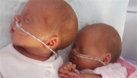 Twins Trust Twin Anaemia Polycythaemia Sequence Taps