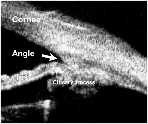 Ubm Image Of An Eye Ubm Shows The Structure Of Angle However It Can Download Scientific