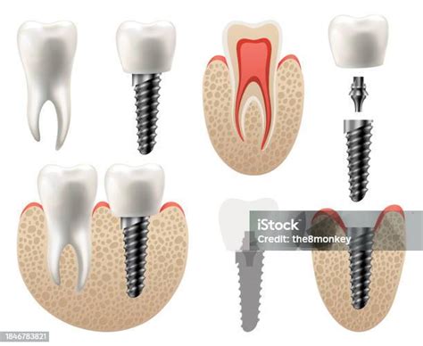 치과 임플란트 구조 의료 교육 인포 그래픽 포스터입니다 치아 임플란트 치과의 현실적인 벡터 디자인 임플란트 나사 건강 관리 치과 의사 및 교정 의사 치료 왕관에 대한 스톡
