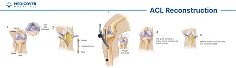 Acl Reconstruction Surgery Indications Procedures And Recovery