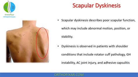 Scapular Dyskinesis In 2024 Scapular Rotator Cuff Pectoralis Muscles