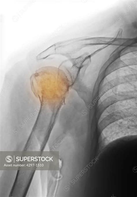 Colorized X Ray Of An Upper Humerus Fracture In An 81 Year Old Woman