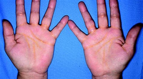 High Cholesterol Hypercholesterolemia Symptoms And Signs Optinghealth