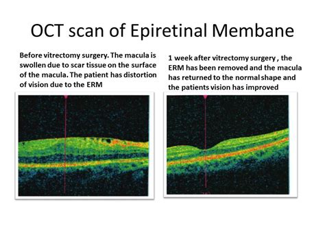Epiretinal Membrane Retina Specialists