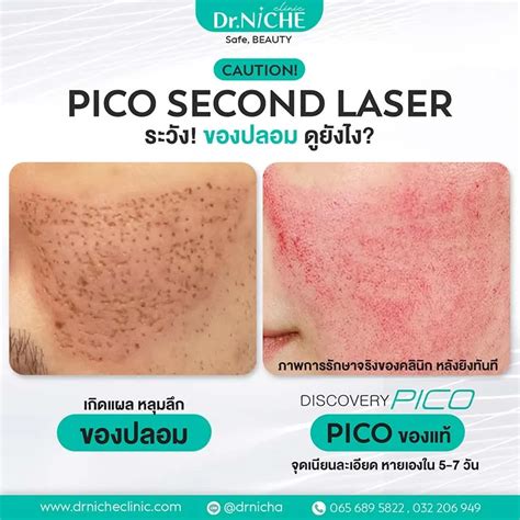 Pico Laser ของปลอม ของแท้ ดูอย่างไรไม่ให้โดนหลอก