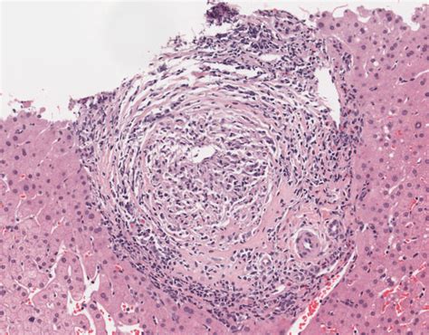 Primary Biliary Cholangitis Pbc Mypathologyreport