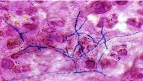 Gram Positive Bacilli Branching Or Partially Acid Fast Bacilli Flashcards Quizlet