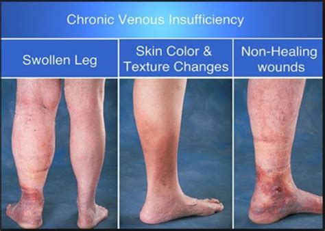 Venous Disease Of The Lower Extremity Flashcards Quizlet