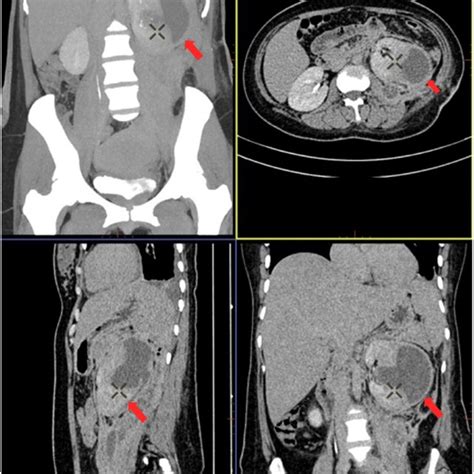 Ct Scan Abdomen With Contrast Showed Red Arrow Hyperdense Lesion