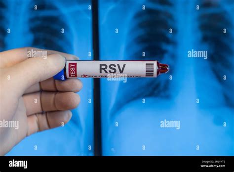 Blood Collection Tubes Respiratory Syncytial Virus RSV Test Positive Results Medical Concept