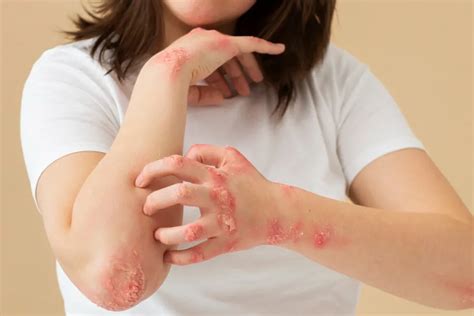 How To Prevent The Spread Of Scabies On The Skin 4 Tips
