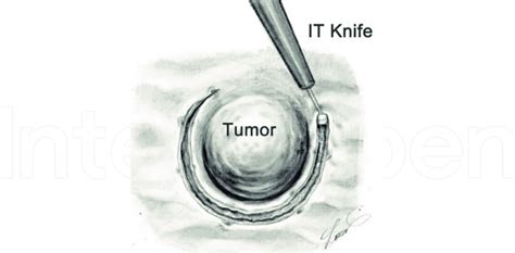 Endoscopic Submucosal Resection Around The Tumor And Artificial Download Scientific Diagram