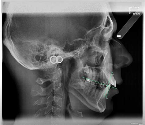 Wits Analysis ⏤ Cephalometric Services Platform