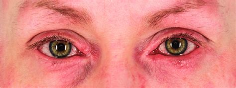 Moderate Conjunctivitis And Blepharitis At Week 22 Of Dupilumab Treatment Download Scientific
