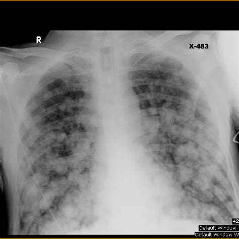 Chest X Ray Showing Multiple Nodular Lesions Involving Both Lungs Download Scientific Diagram