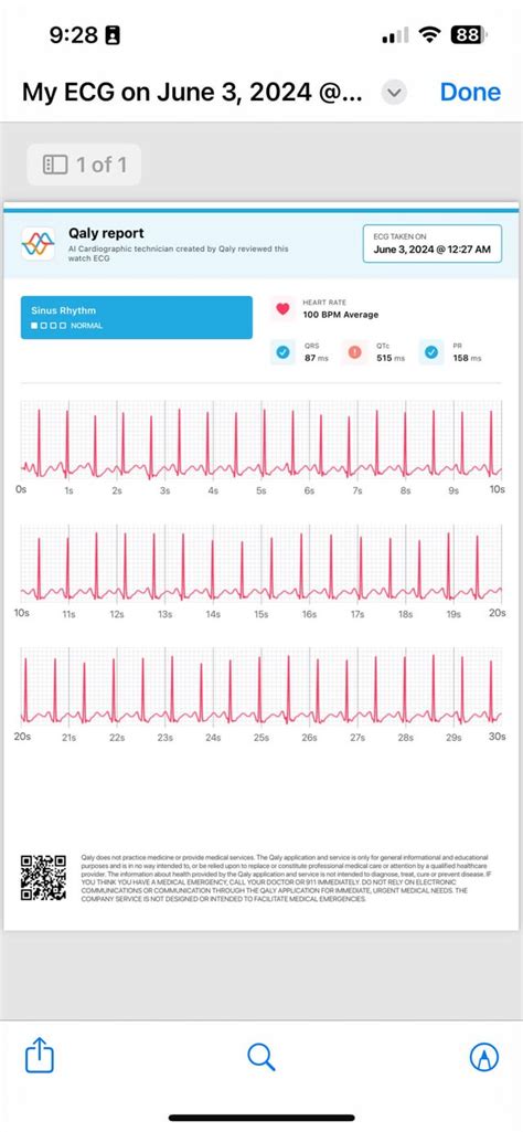 Prolonged Qt Interval R Askcardiology