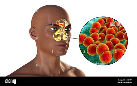 Bacterial Sinusitis Computer Illustration The Sinuses Are Membrane