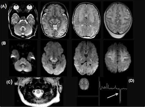 Ten Day Old Newborn With Ndufs6 Variant Axial T2w Brain Mri Images