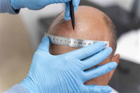 Scalp Micropigmentation All Your Questions Answered Scalp Designs