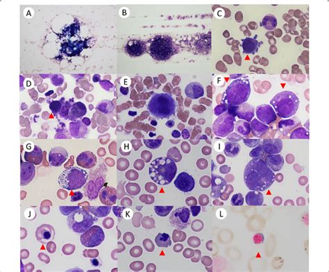 Bone Marrow Findings In Patients With Pearson Syndrome Bone Marrow Can