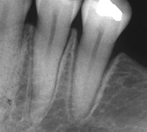 Identifying Tooth S Dental Images Flashcard