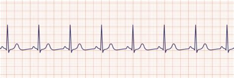 Ecg Flashcards Quizlet
