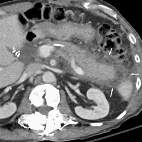 Interstitial Edematous Pancreatitis In A 69 Year Old Female Axial Download Scientific Diagram