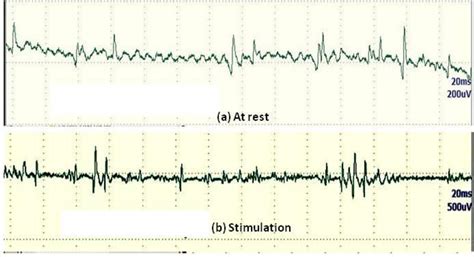 JLE Sexologies The Diagnosis Value Of Needle Electrode Electromyography In Vaginismus