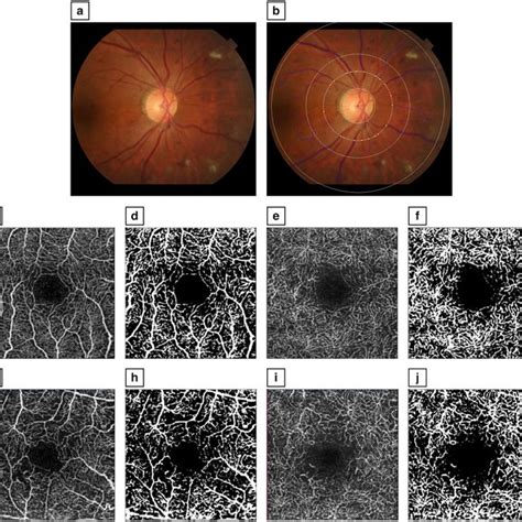 Measurement Of Retinal Arteriolar Venular And Capillary Parameters Download Scientific