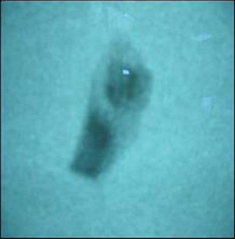 Operative Specimen With Its Intraoperative Radiograph Download