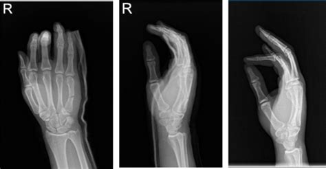 Closed Reduction And Internal Fixation Metacarpal Ny