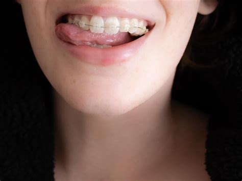 Ilovebraces