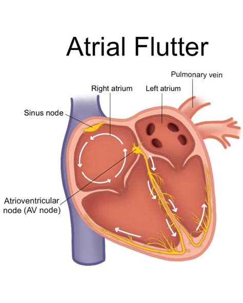 Atrial Flutter Ablation Dr Karthigesan