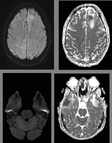 Myeloid Sarcoma Pacs