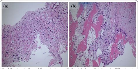Figure 1 From Hyperdense Pleural Metastasis From Osteosarcomatous
