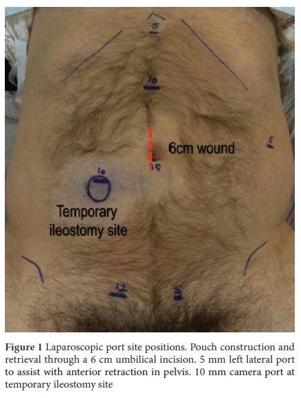 Proctocolectomy With J Pouch