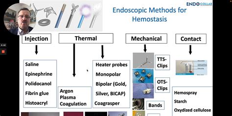 Master Post Polypectomy Bleeding An Endoscopists Guide To Prevention And Treatment