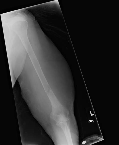 Shoulder And Elbow Surgery Intramedullary Nailing Of Bilateral Pathologic Humerus Fractures