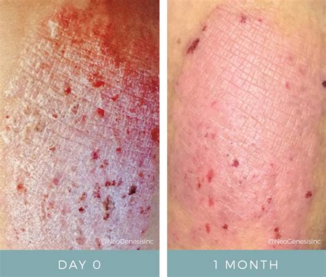 Soothe Chronic Dermatitis With Neogenesis Recovery Serum