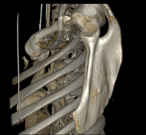 Left Sided Type Vi Subcoracoid Acromioclavicular Joint Acj Download Scientific Diagram