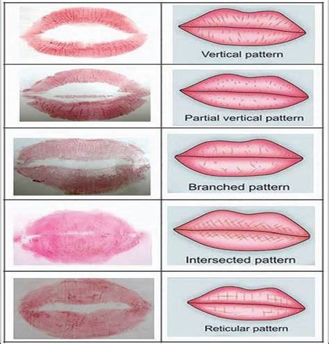 Personal Identification And Sex Determination Using Cheilosc Journal Of Indian Academy Of