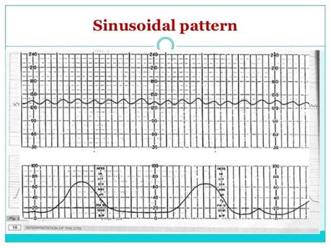 Updated Intrapartum Monitoring