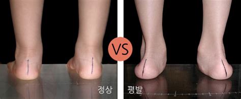 평발 아이레그플러스의원