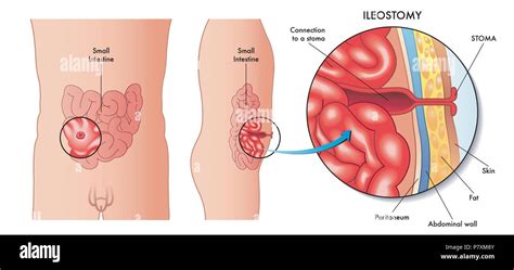 Colostomy Diagram