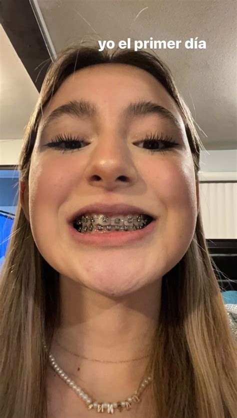 Pin De Juan Carlos Figueroa En Las Jm Brackets Dentales Frenillos