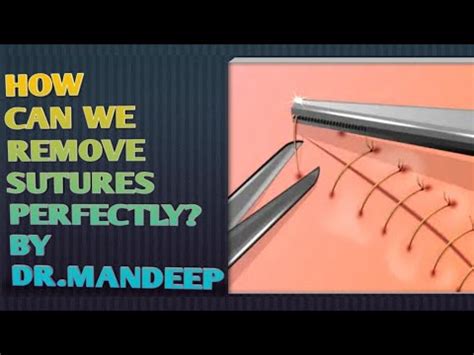 15 How To Remove Sutures Perfectly YouTube