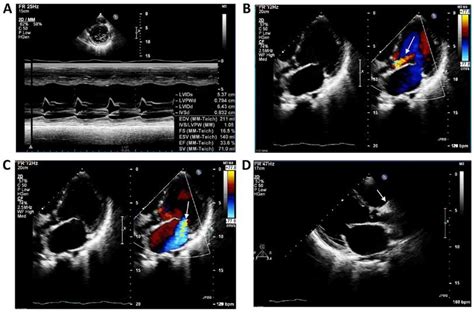 Echocardiogram Pictures Show Reduced Cardiac Functions Of The Patient Download Scientific