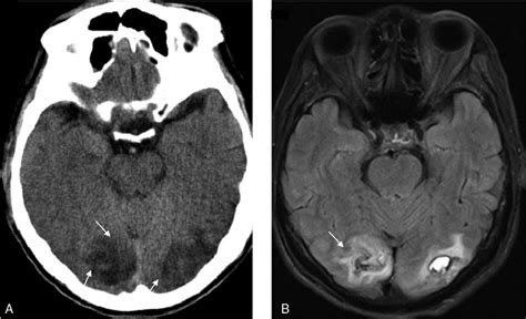 A The Brain Ct Scan Shows Suspicious Hyperdense Zones In Bilateral Download Scientific